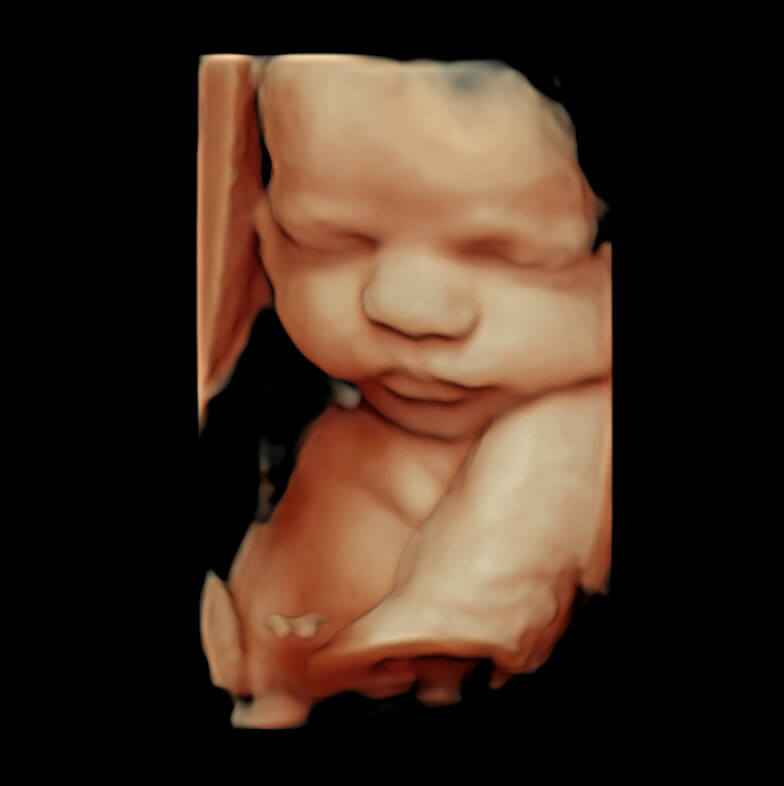 4D ultrahang babafotók - 4d Ultrahang Nobilis magánrendelő Debrecenben