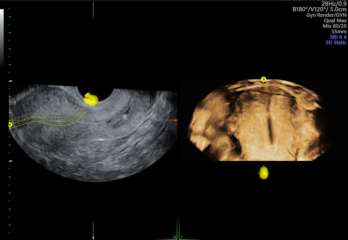 Nőgyógyászati ultrahang szűrővizsgálat - 4d Ultrahang Debrecen