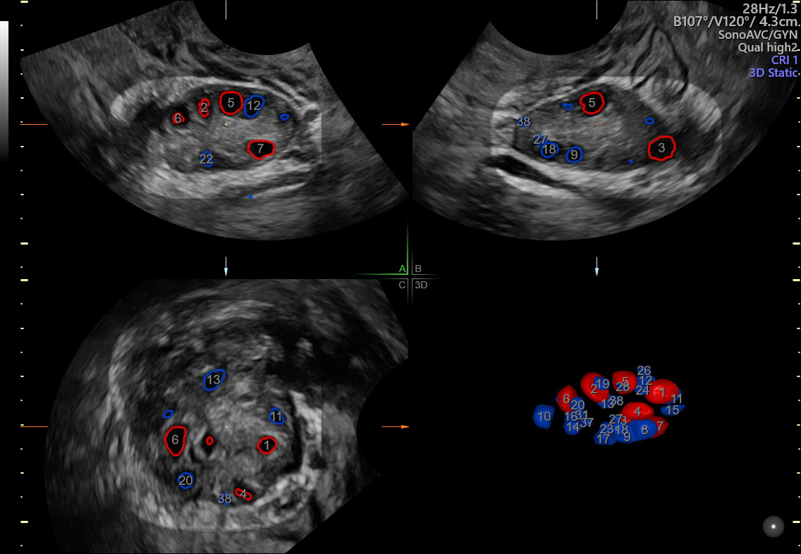 Nőgyógyászati ultrahang szűrővizsgálat - 4d Ultrahang Debrecen